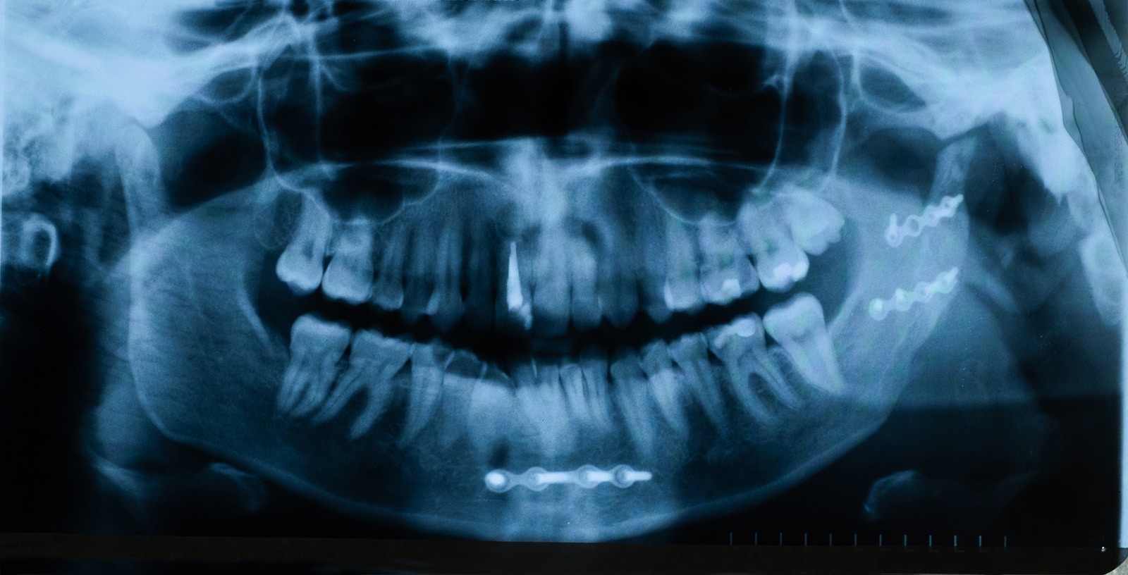 Bone Injury Treatment in Boulder, Brighton & Denver, CO